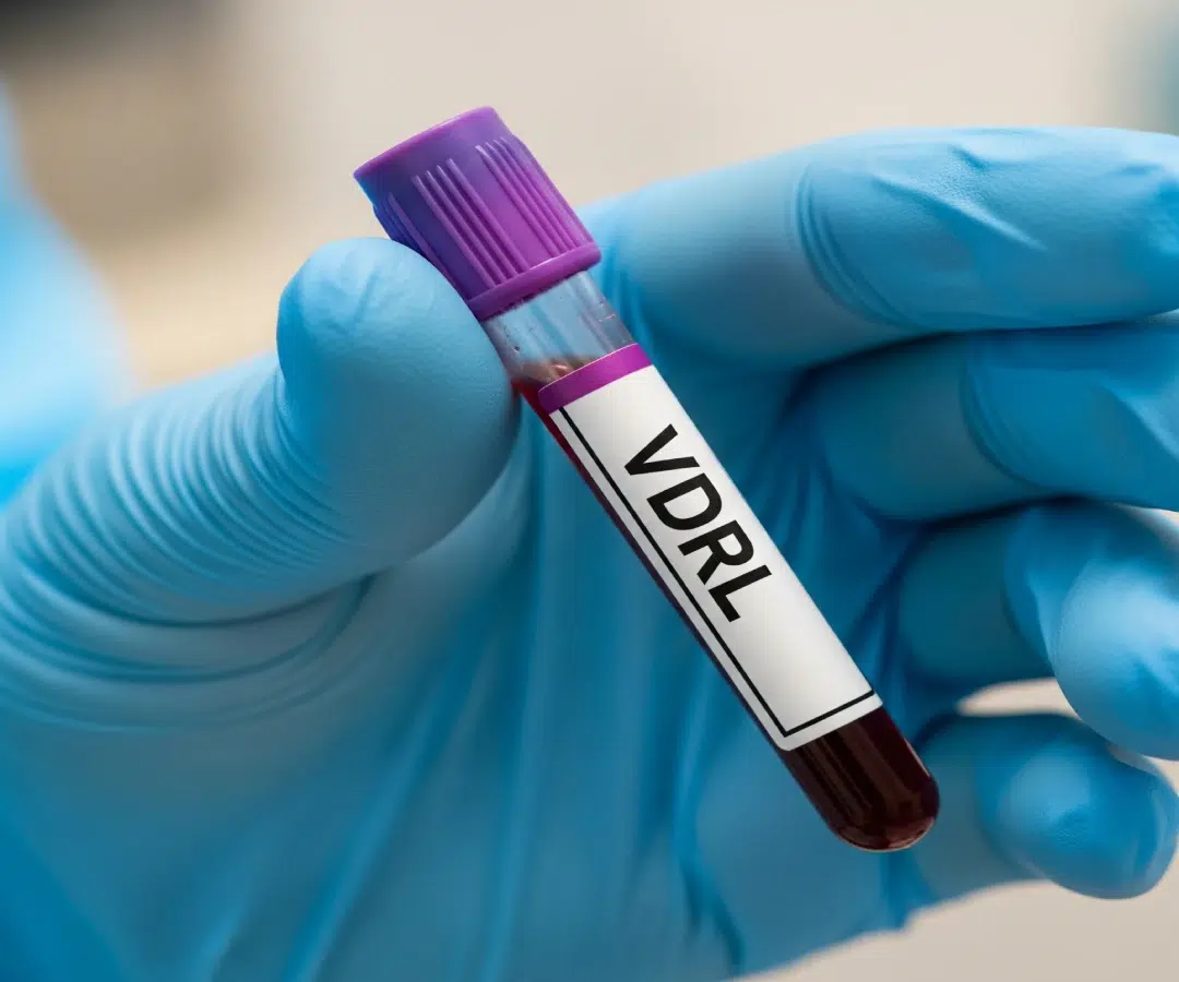 VDRL Reagente: O Que Fazer? Significado, Causas e Tratamento